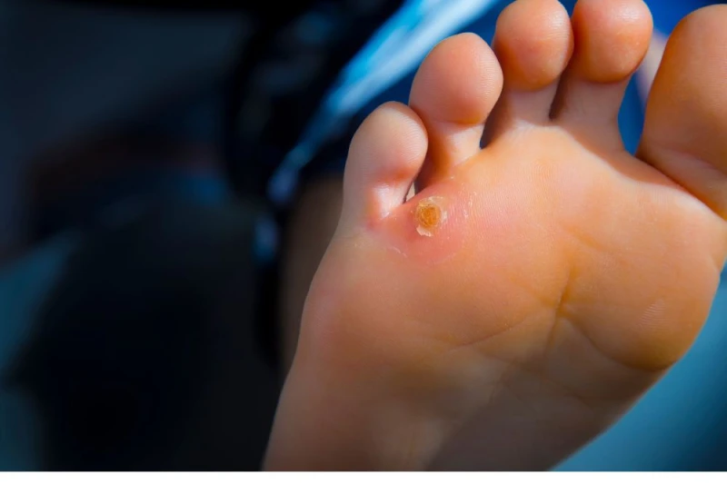 Understanding Foot Corns: Symptoms, Removal, and Risk