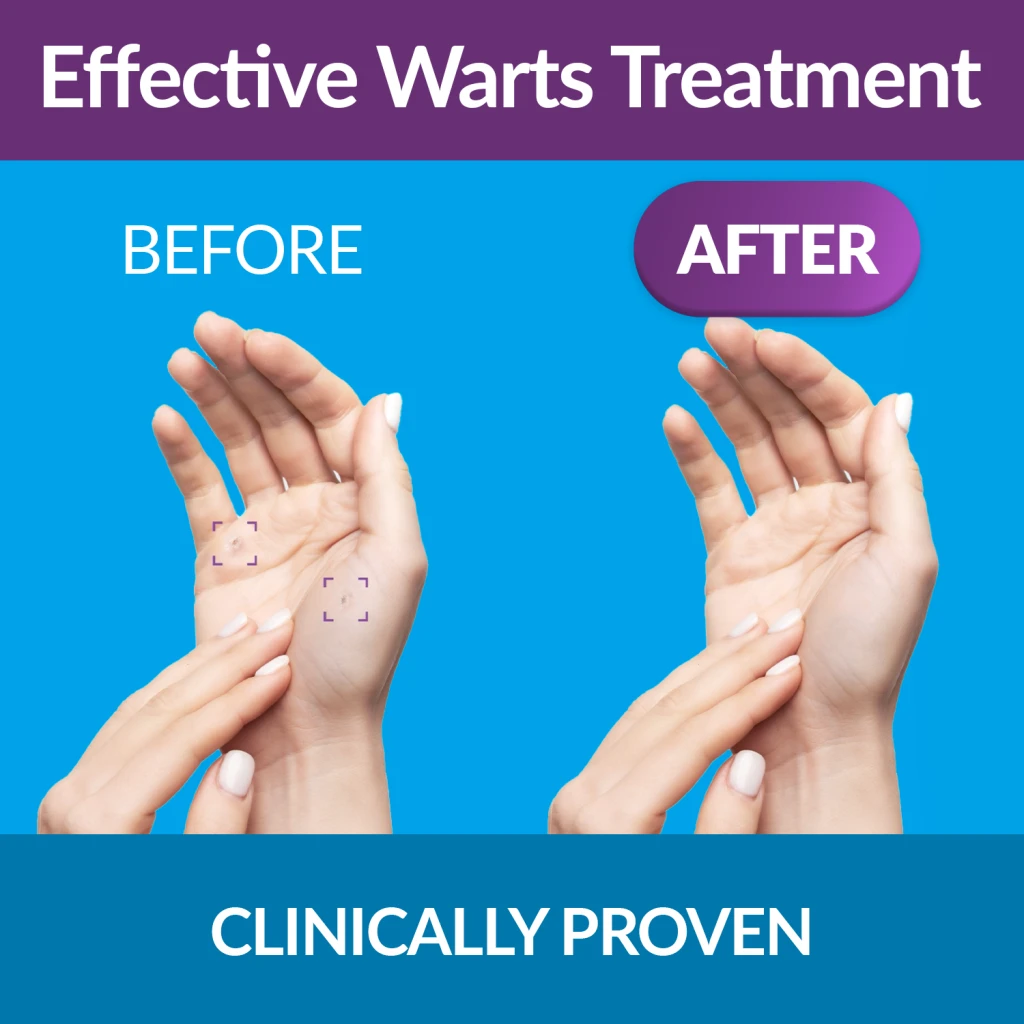 Excilor Warts Treatment : Effective gel treatment