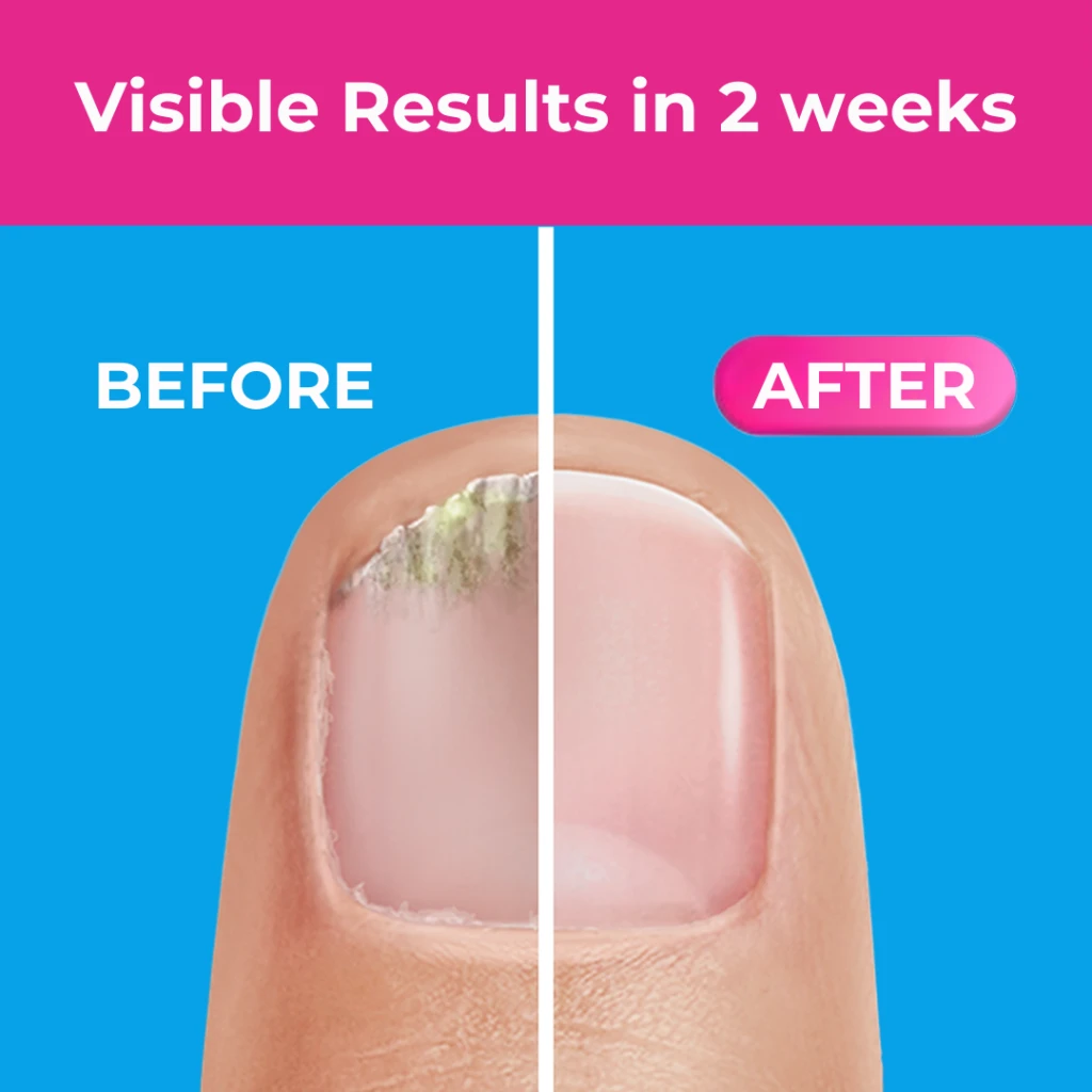 Excilor Nail Fungus Solution, Effective Brush Treatment