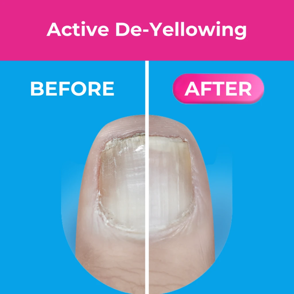 Excilor Nail Fungus Easy Pen: Clinically Proven Treatment