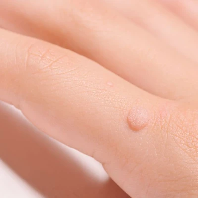 What are the different types of warts?