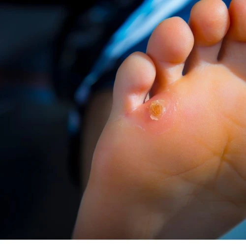 Understanding Foot Corns: Symptoms, Removal, and Risk