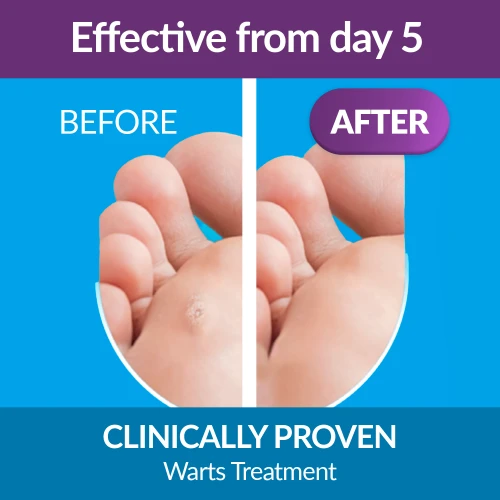 Excilor Warts Duo Power : Extra Strong Cryo + Acid Treatment