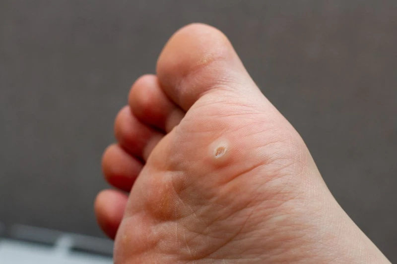 Plantar warts: how do you treat warts on your foot?
