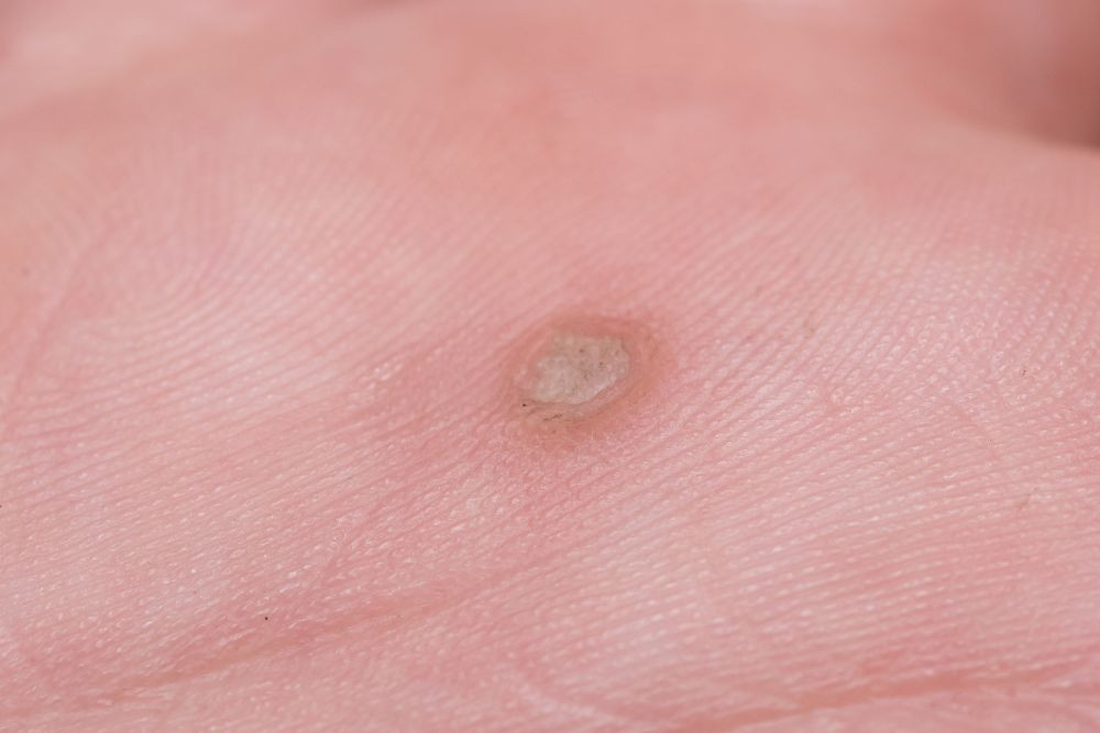 Quels sont les différents types de verrues de la peau