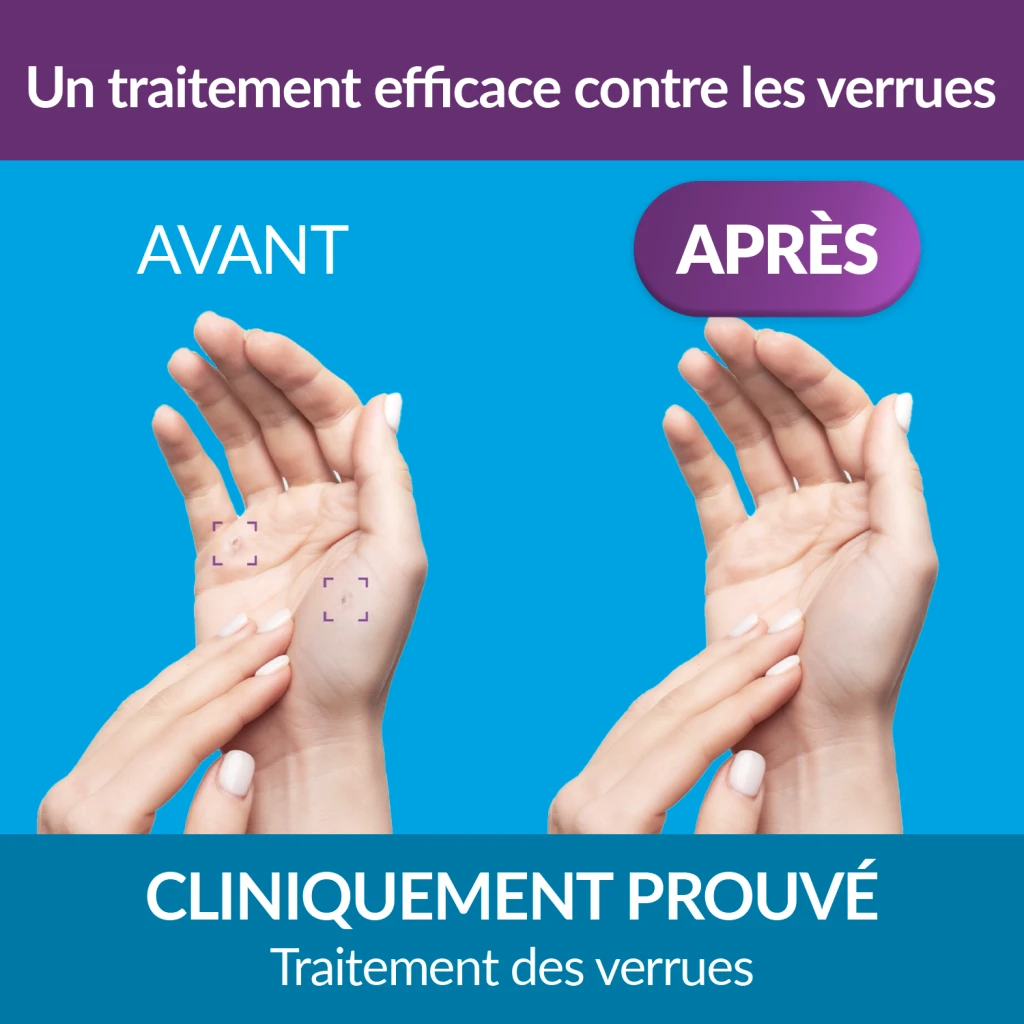 Excilor Cryo Verruxit traitement verrue par le froid
