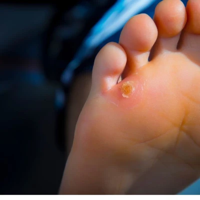 Durillon : comment le reconnaître ? Quel traitement