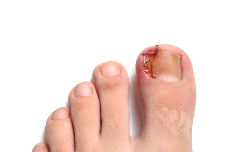 Ongle incarné : quels symptômes ? Comment le soigner