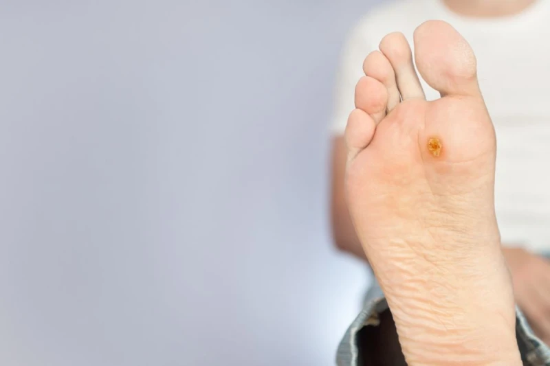 Comment peut-on vraiment savoir si une verrue est morte
