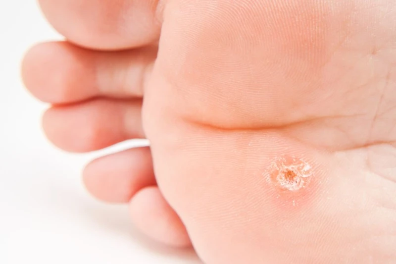 Durillon : comment le reconnaître ? Quel traitement