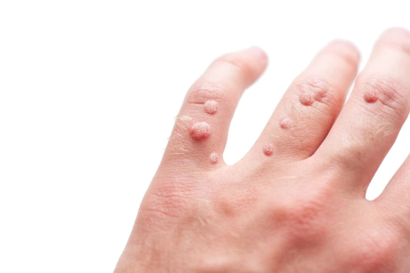 Verrues sur les mains : comment s’en débarrasser