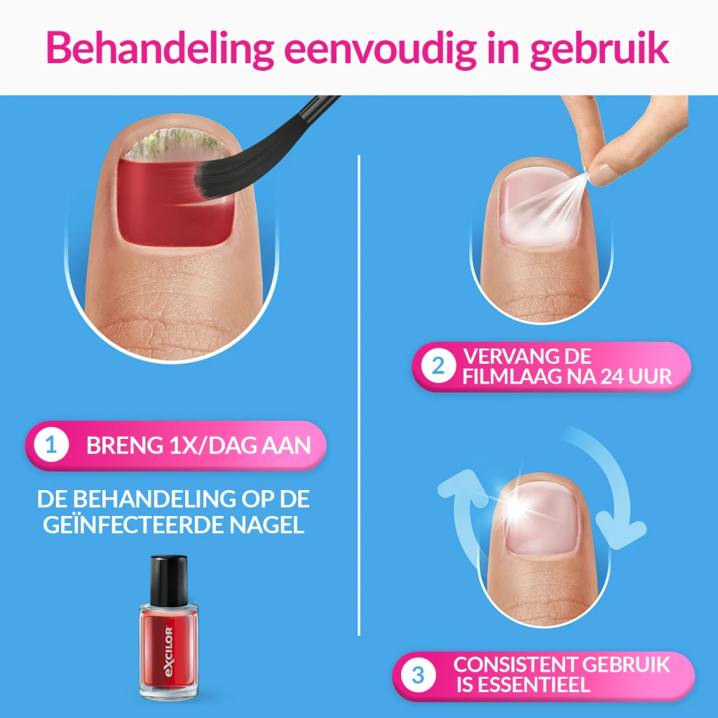 Excilor Forte Color behandeling tegen schimmelnagels