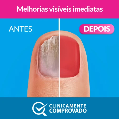 Excilor Forte Color Red contra os fungos das unhas